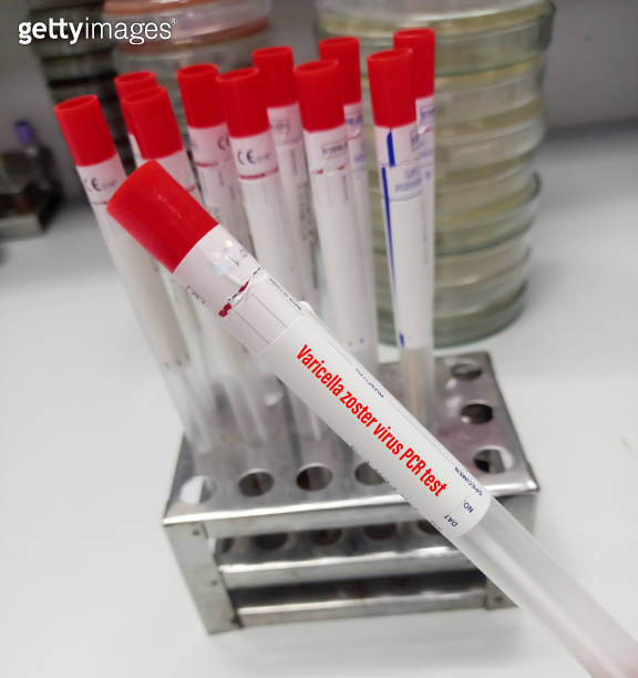 Wound swab for Varicella-Zoster Virus PCR test, laboratory background ...