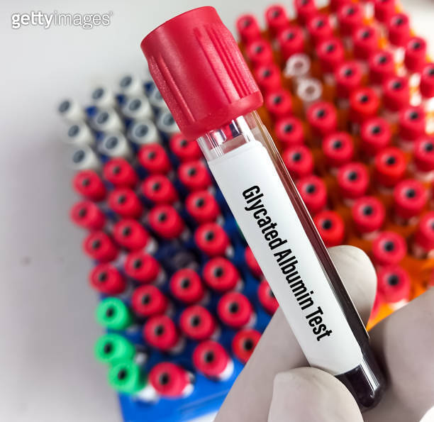 Blood sample for Glycated Albumin test or Fructosamine test that ...