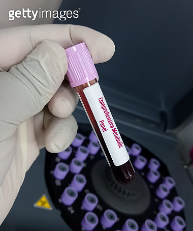 Blood sample tube for analysis of Comprehensive Metabolic Panel (CMP ...