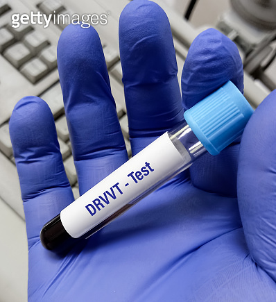 Scientist holding blood sample for dRVVT(Diluted Russell Viper Venom ...