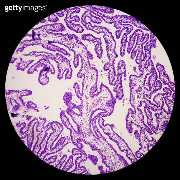 Fallopian tube(biopsy): features of hydrosalpinx(Blocked Fallopian Tube ...