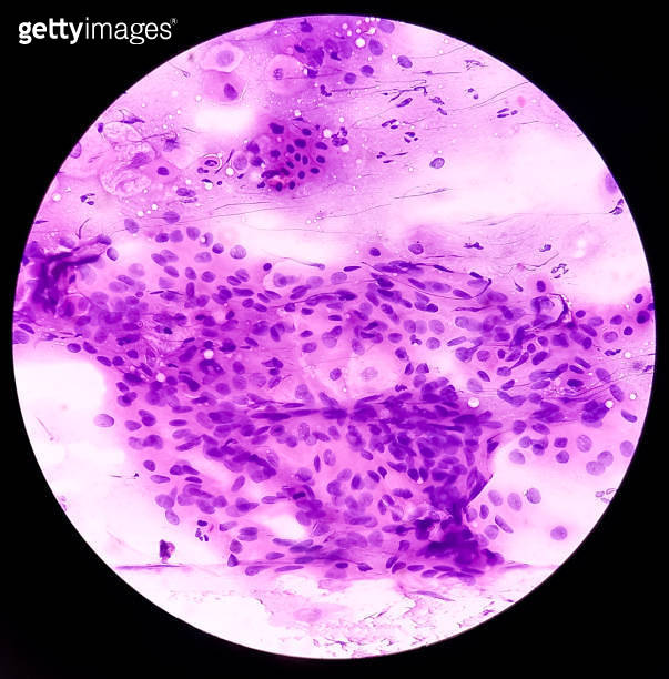 Pap's smear. Microscopic showing inflammatory smear with early atrophic ...