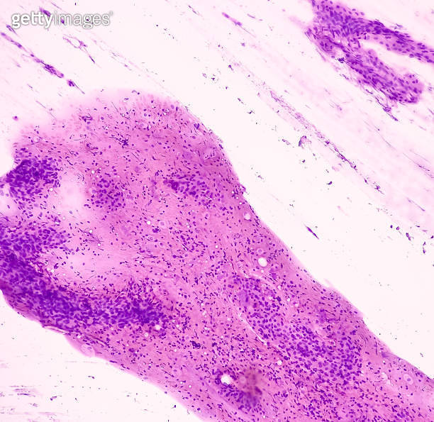 Pap's smear. Microscopic showing inflammatory smear with early atrophic ...