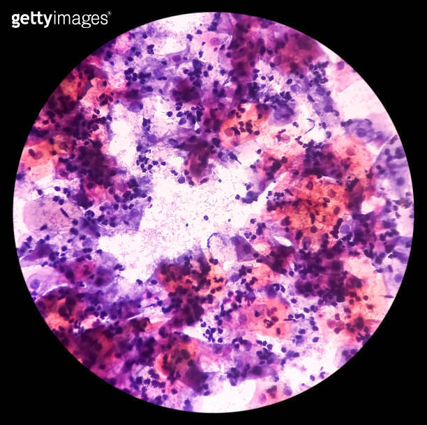 Abnormal squamous epithelial cells view in microscopy. HPV criteria for ...