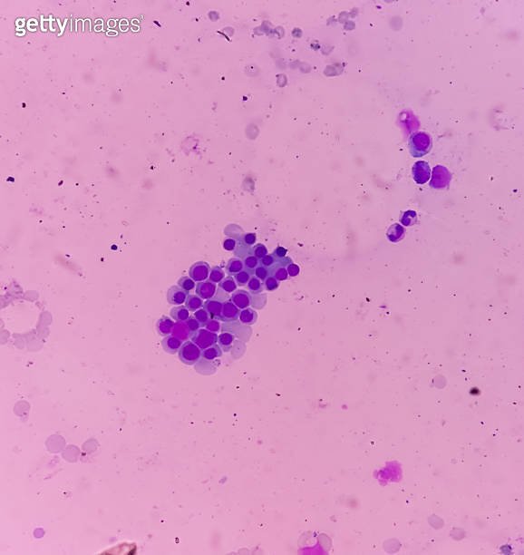 Bone marrow study: a megakaryocyte is a large bone marrow cell with a ...