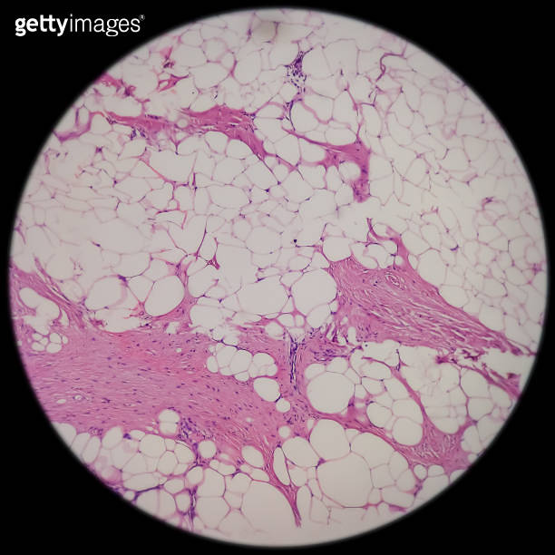 Lipoma, benign growth of fatty tissue, benign neoplasm, adipocytes ...
