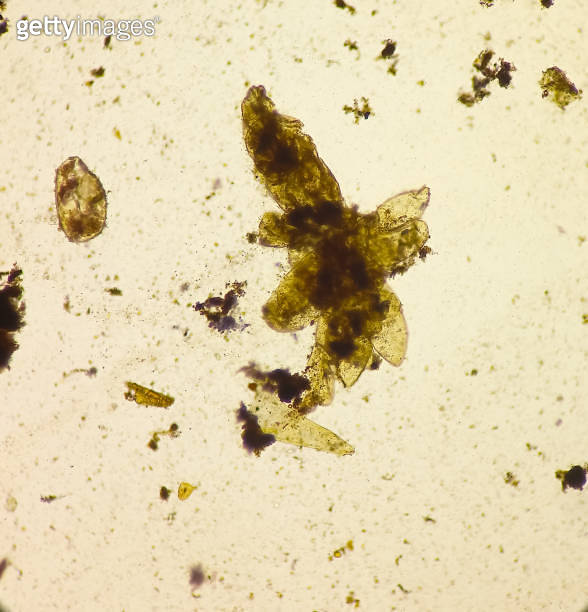 Stool examination under light microscopy, fat globules, plenty yeasts ...