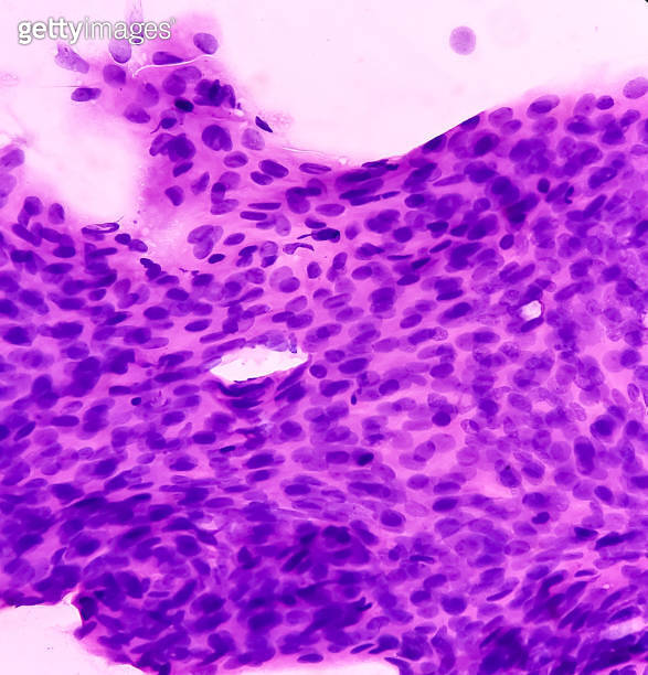 Pap's smear. Microscopic showing inflammatory smear with early atrophic ...