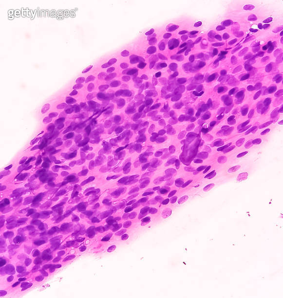 Pap's smear. Microscopic showing inflammatory smear with early atrophic ...