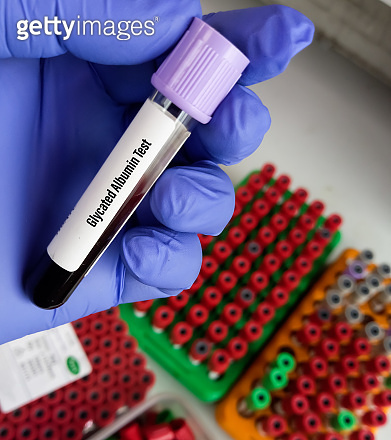 Blood sample for Glycated Protein test or Fructosamine test that ...