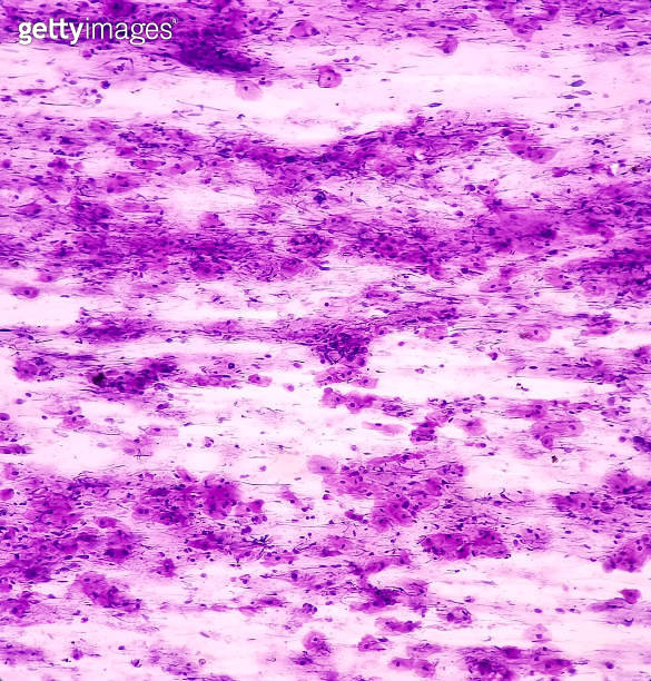 Pap's smear, microscopic 40x show high-grade squamous intraepithelial ...