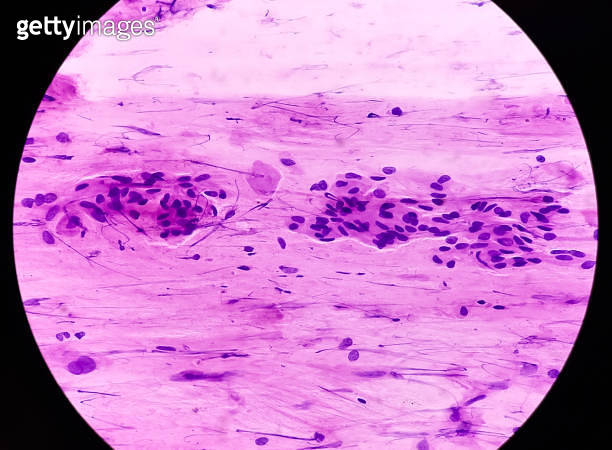 Pap's smear, microscopic 40x show high-grade squamous intraepithelial ...
