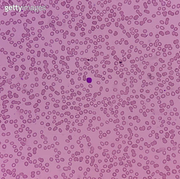 Acute promyelocytic leukemia(APL, APML). Blast cells, a type of blood ...