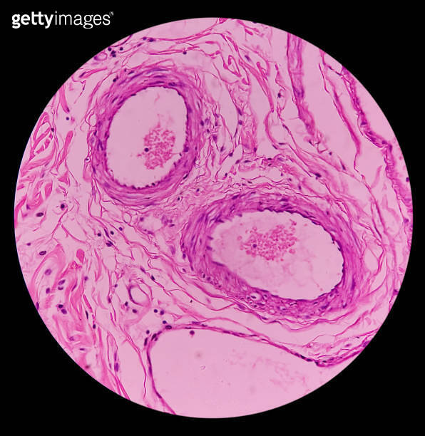 Microscopic show fallopian tube, features of Hydrosalpinx(Fallopian ...