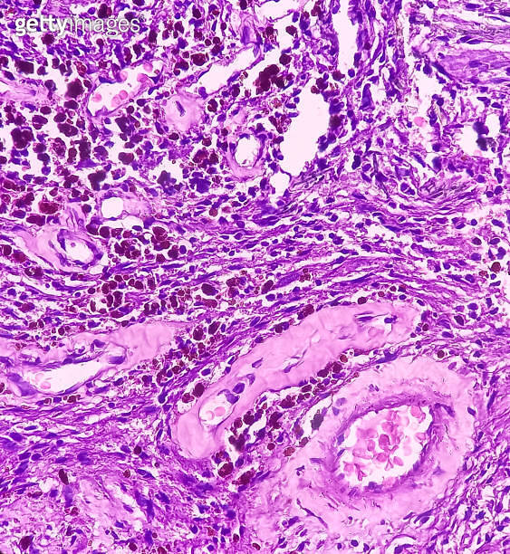 Photomicrograph of Schwannoma, a benign soft tissue tumor, enlarged ...