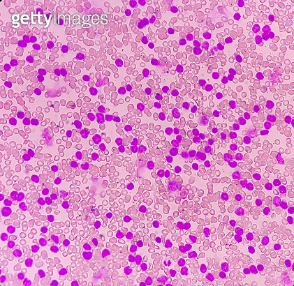Acute leukemia, peripheral blood smear show most of cell are blast cell ...