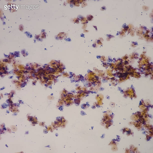 Abnormal squamous epithelial cells view in microscopy. HPV criteria for ...