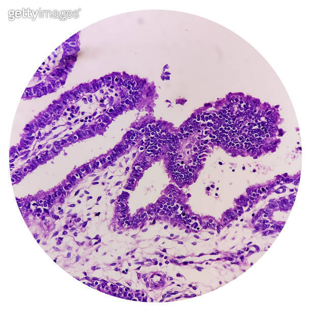 Fallopian tube(biopsy): features of hydrosalpinx(Blocked Fallopian Tube ...