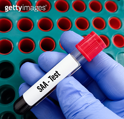 Hand holding a blood sample for SAA(Serum Amyloid A) test, early and ...