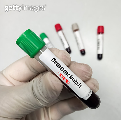 Blood sample for Chromosome analysis fetal blood to help diagnose ...
