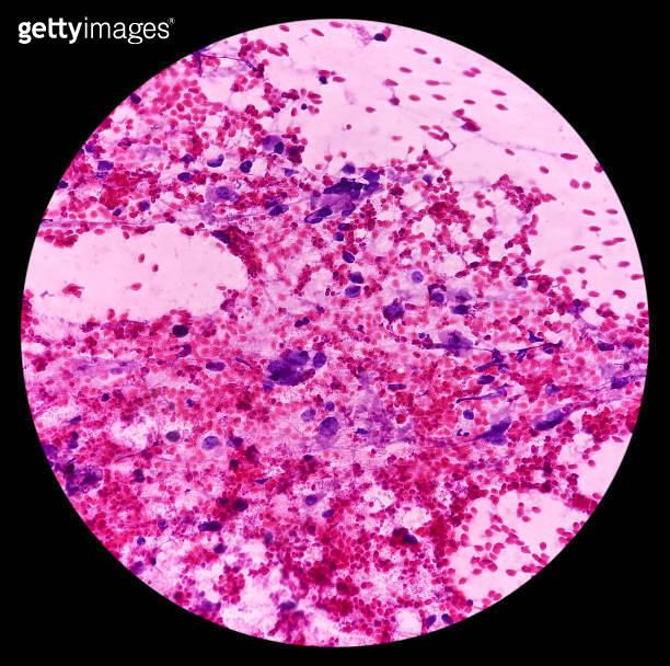 Metastatic Squamous cell carcinoma, Cholangiocarcinoma, adenocarcinoma ...