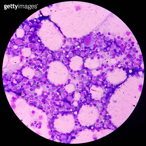 Bone marrow study: a megakaryocyte is a large bone marrow cell with a ...