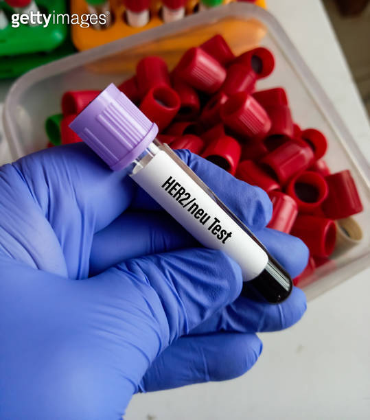 Blood sample for Her2/neu test, diagnosis of breast cancer. human ...