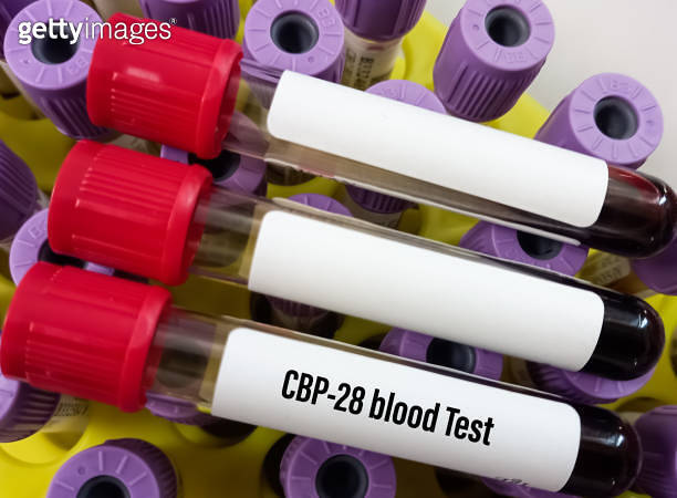 Blood sample for CBP-28 blood test. It's a protein hormone and ...