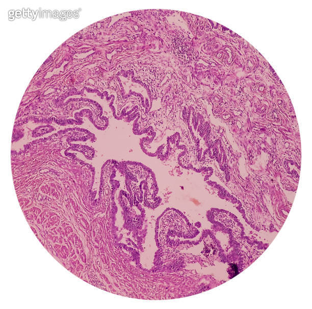 Microscopic show fallopian tube, features of Hydrosalpinx(Fallopian ...