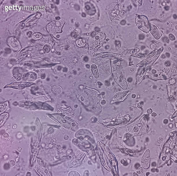 Photomicrograph close view of Abnormal urine analysis under light ...