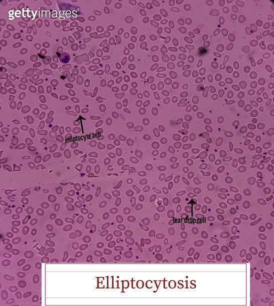 Hereditary elliptocytosis, hereditary disorder of RBCs, Ovalocytes or ...
