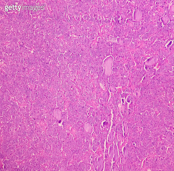 Follicular adenoma of thyroid gland, light micrograph. Histopathology ...