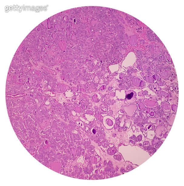 Follicular adenoma of thyroid gland, light micrograph. Histopathology ...
