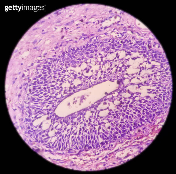 Tissue from endometrial polyp: Ovarian polyp, show myomatous polyp 이미지 ...