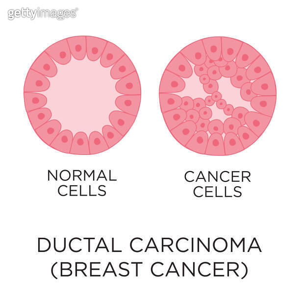 Ductal carcinoma (breast cancer) cells flat style vector illustration ...