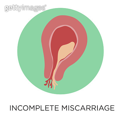 Incomplete miscarriage flat style vector illustration in circle layout ...