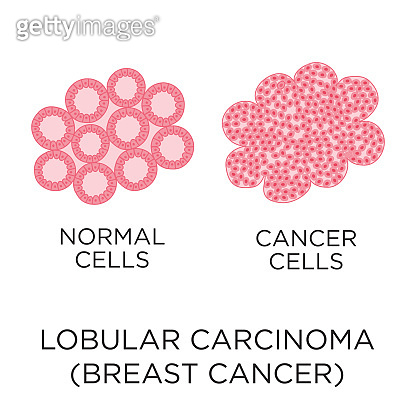 Lobular carcinoma (breast cancer) cells flat style vector illustration ...