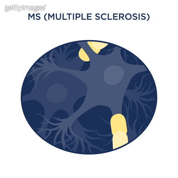 MS Multiple Sclerosis vector medical drawing showing brain neurons ...