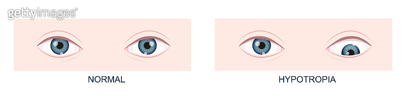 Hypotropia. Vertical strabismus. Human eyes healthy and with downward ...