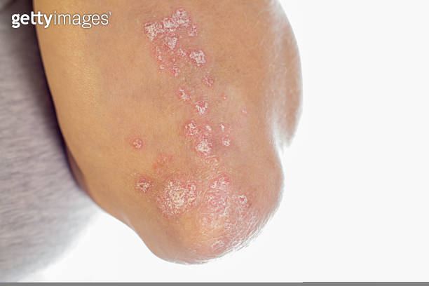 Psoriasis on elbows .Close up autoimmune incurable dermatological skin ...