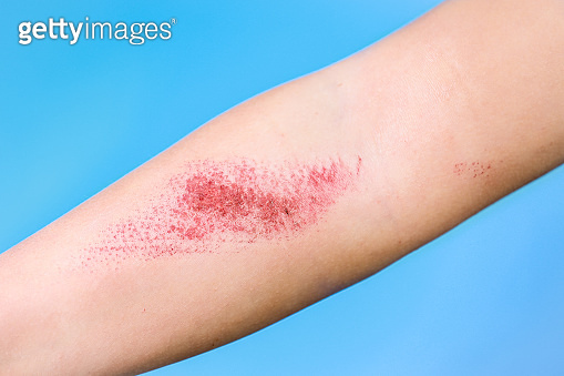 Children's hand burn. Children's hand with a burnt wound on a blu ...