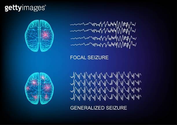 Illustration of seizure types demonstrating by onset and brain waves on ...