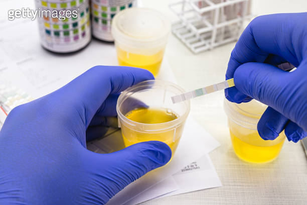 urine test, made with a vial of Urinalysis Reagent Strip used for ...