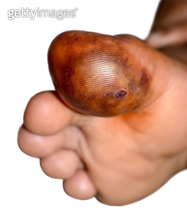 Abscess and cellulitis or Staphylococcal, Streptococcal skin infection ...