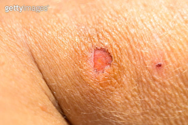 Detail of a healing wound on a persons arm 이미지 (1411202961) - 게티이미지뱅크
