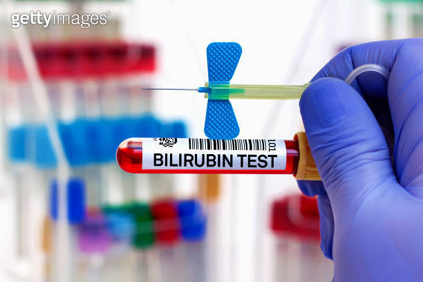 doctor with Blood tube and needle for Bilirubin test 이미지 (1380366864 ...