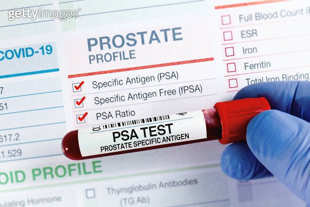 Blood sample for analysis of PSA Prostate Specific Antigen profile test ...