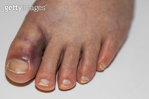 Close up view of damaged foot female with with bruise big toe. Injuries ...
