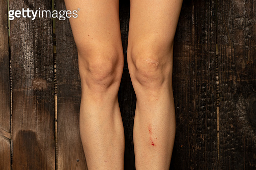 Female legs with a wound on the leg after a fall on the background of a ...
