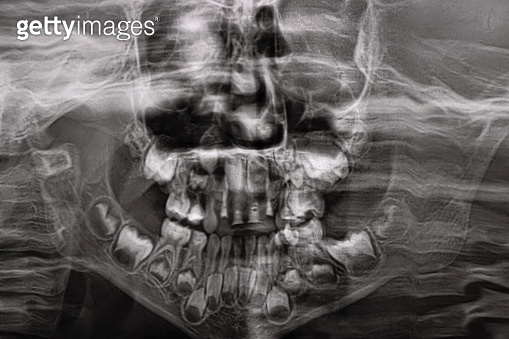 The panoramic image shows several embedded and impacted teeth in both ...